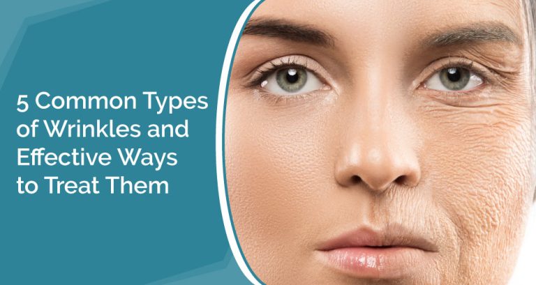 5 Common Types of Wrinkles and Effective Ways to Treat Them