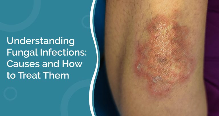 Understanding Fungal Infections: Causes and How to Treat Them