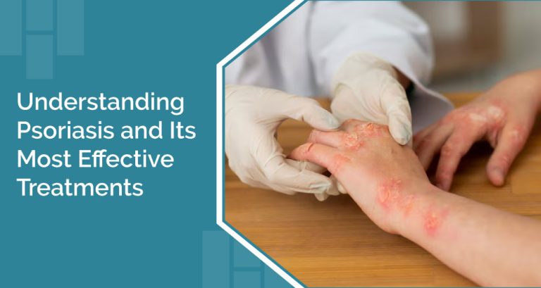 Understanding Psoriasis and Its Most Effective Treatments