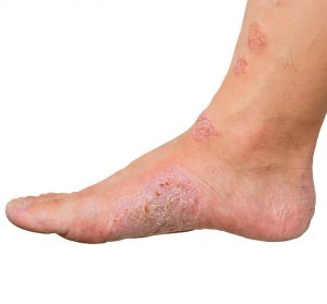 Fungal Infection Treatment in Vile Parle, Mumbai