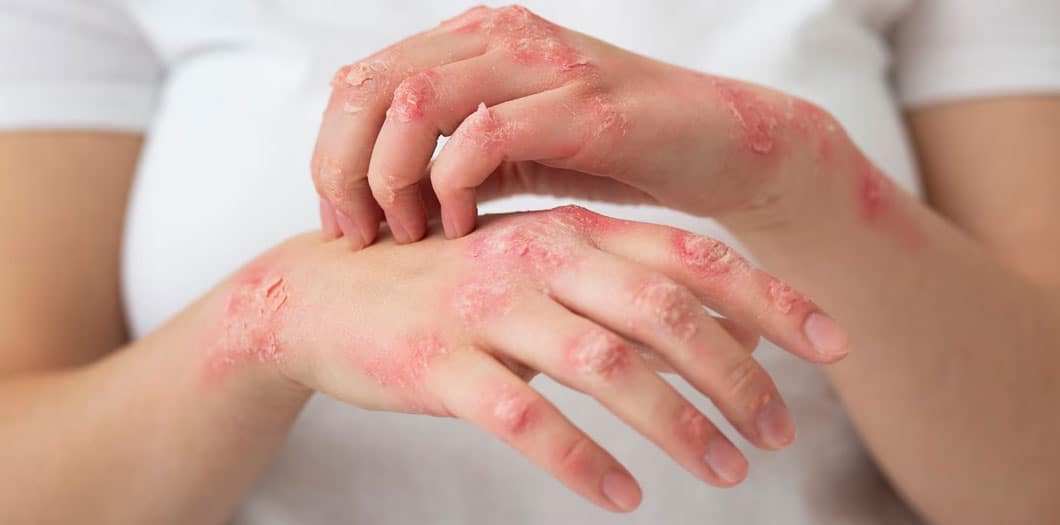 Fungal Infection Treatment in Vile Parle, Mumbai